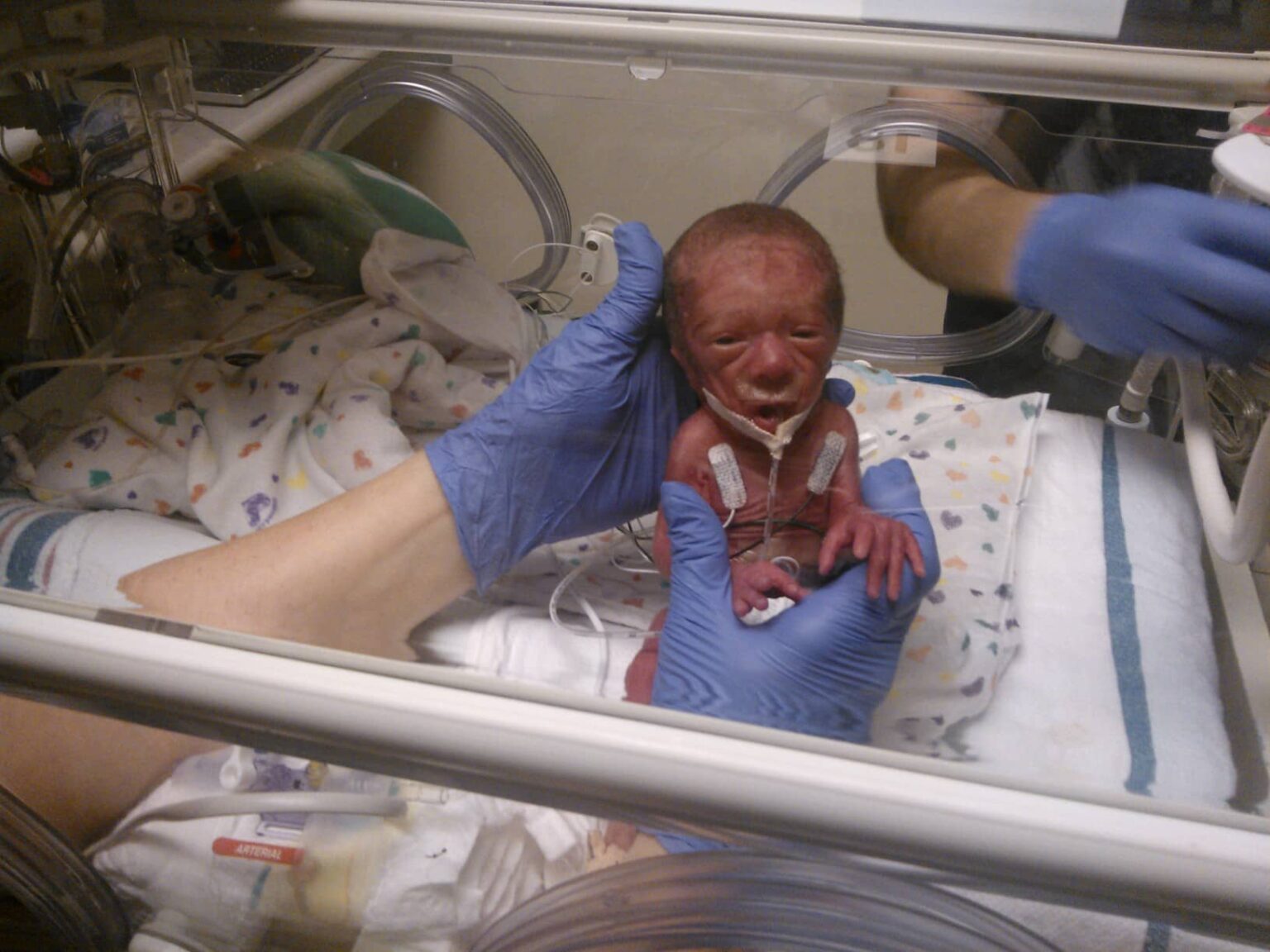 Milk Recipients John and Sam: Micro Preemie Twins